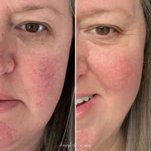 My Experience with Laser Treatment for Rosacea including Before & After ...