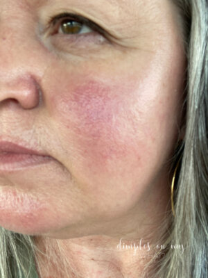 My Experience with Laser Treatment for Rosacea including Before & After ...