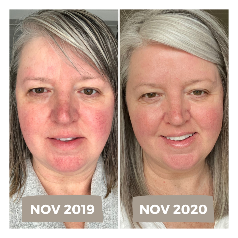 My Experience with Laser Treatment for Rosacea including Before & After ...
