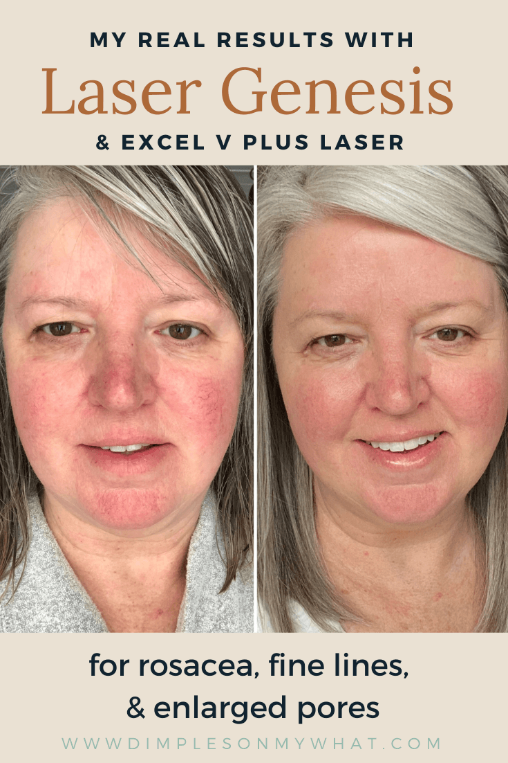 My Experience with Laser Treatment for Rosacea including Before & After ...